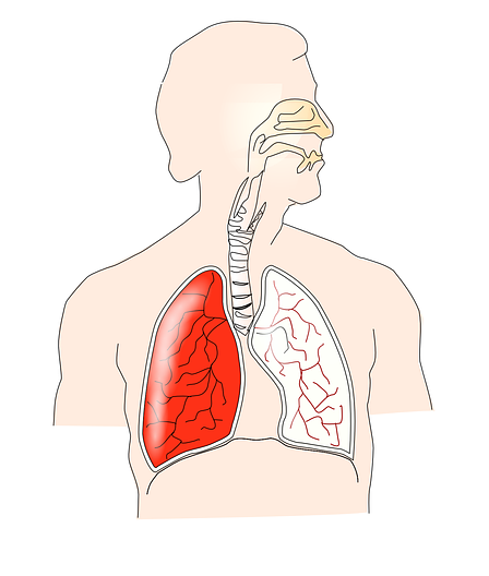 Pulmonía: Síntomas, Causas y Tratamientos Efectivo. ⤵️